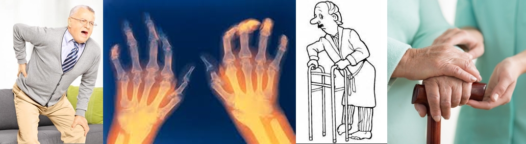 Autoimmun betegségek gyógyítása: Rheumatoid arthritis (reuma)